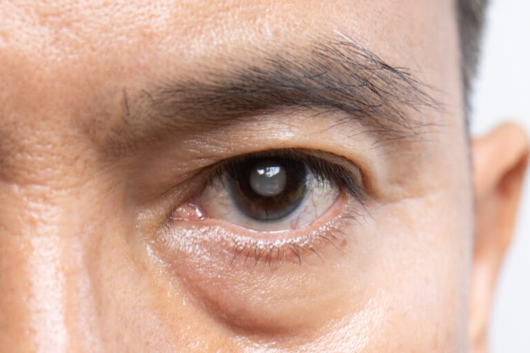 How to Manage Blurry Vision After Cataract Surgery: When to Seek Help ...